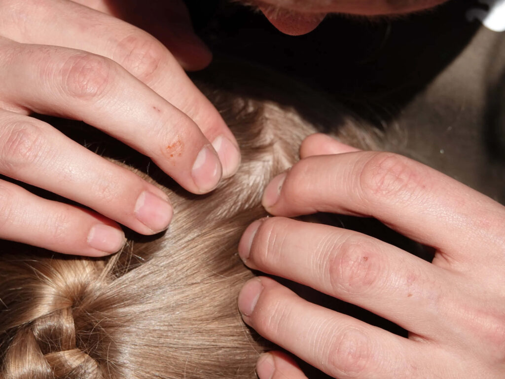 Scalp Acne: Treatment, Causes, and Prevention